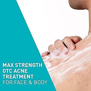 CeraVe Acne Foaming Cream Wash, Gentle Face and Body Cleanser with Benzoyl Peroxide 10%, Hyaluronic Acid, and Niacinamide, 10% Benzoyl Peroxide Treatment Clears Pimples and Blackheads 5 Oz