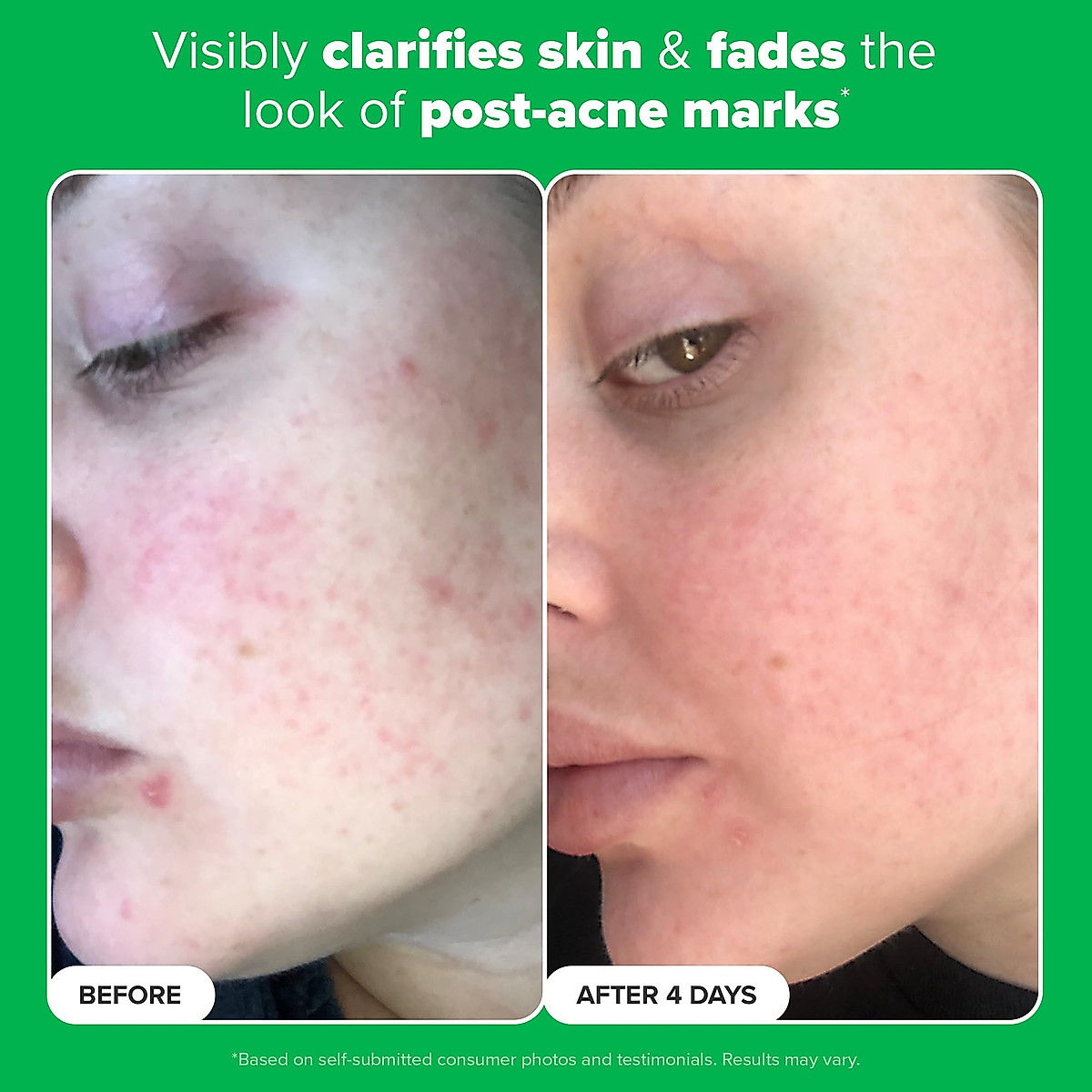 Paula’s Choice BOOST 10% Azelaic Acid Booster Cream Gel, Oil-Free Serum Fades Discoloration & Post-Blemish Marks, with Licorice Extract & Salicylic Acid, Fragrance-Free, 0.17 Fl. Oz.