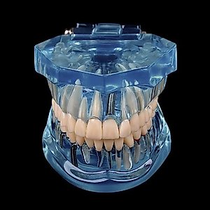 Dental Implant Model Teeth Typodont Model Dental Implant Restoration Training Tooth Pathologies Disease Demonstration Removable Teeth Teaching Studying