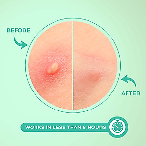 Pimple Patch Acne Treatment (Tea Tree Oil) - 120 Count, Acne-Healing Hydrocolloid Bandages (3 Sizes), Discreet Acne Dots Hydrocolloid Acne Patch, Pimple Patches, Acne Patches for Face & Body Acne