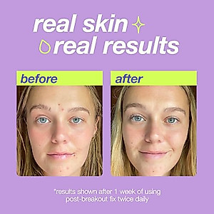 Dermalogica Clear Start Post-Breakout Fix, Acne Dark Spot Treatment with Salicylic Acid, Squalene & Hexylresorcinol, Fade + Brighten Acne Marks