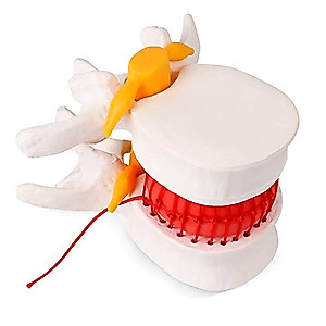 MIIRR Human Lumbar Disc Herniation Model, Vertebral Spine Anatomical Medical Model Perfect for Learning & Teaching Tool - Lumbar Vertebral Spine Model