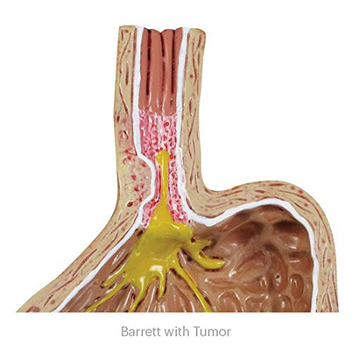 GPI Anatomicals - 4-Piece Stomach Model Set with Gastroesophageal Reflux Disease (GERD), Replica for Human Anatomy and Physiology Education, Anatomy Model for Doctor's Offices, Medical Study Supplies