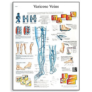 3B Scientific VR3367L Glossy UV Resistant Laminated Paper Afeccion Por Varices, Varicosidades Anatomical (Varicose Veins Anatomical Chart,Spanish), Poster Size 20" Width x 26" Height, Yellow
