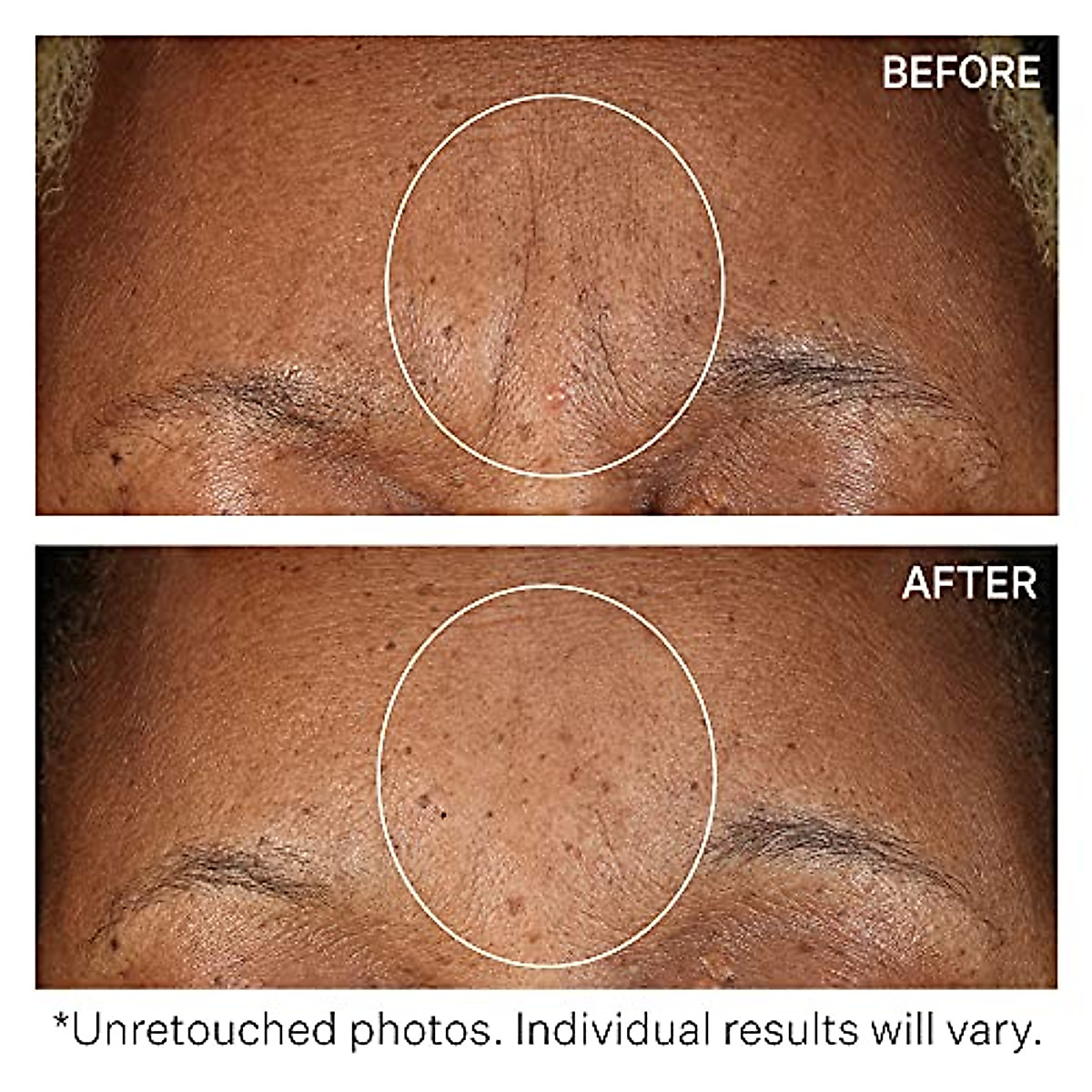 StriVectin Anti-Wrinkle SD Advanced PLUS Intensive Moisturizing Concentrate for Wrinkles and Stretch Marks with Collagen-Targeting Technology, 2 Fl Oz