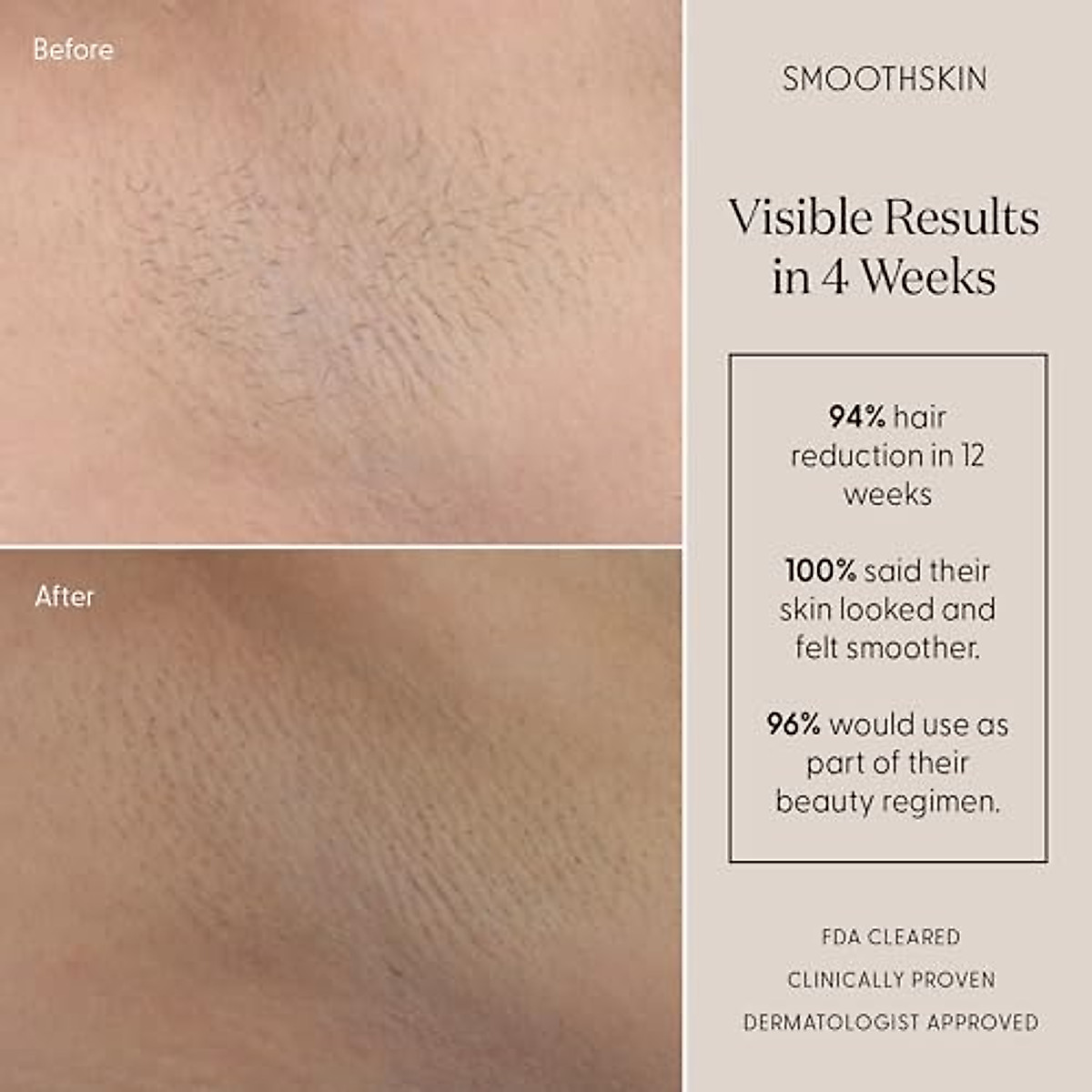 SmoothSkin Pure Mini IPL Laser Hair Removal Device, Long-Lasting, for Body & Facial Hair Removal, Alternative to Laser Hair Removal, Bikini Shaver & Epilator, with Precision Head for Small Areas