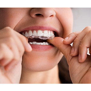 Impact Nightguards Custom Ultra Thin Day Guard 1mm (Dayguard 1MM Upper)