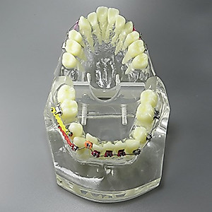 Smile1000 Dental Malocclusion Orthodontic Treatment Teeth Model with Metal Brackets Wires Colorful Ties Chains and Hoops M3005