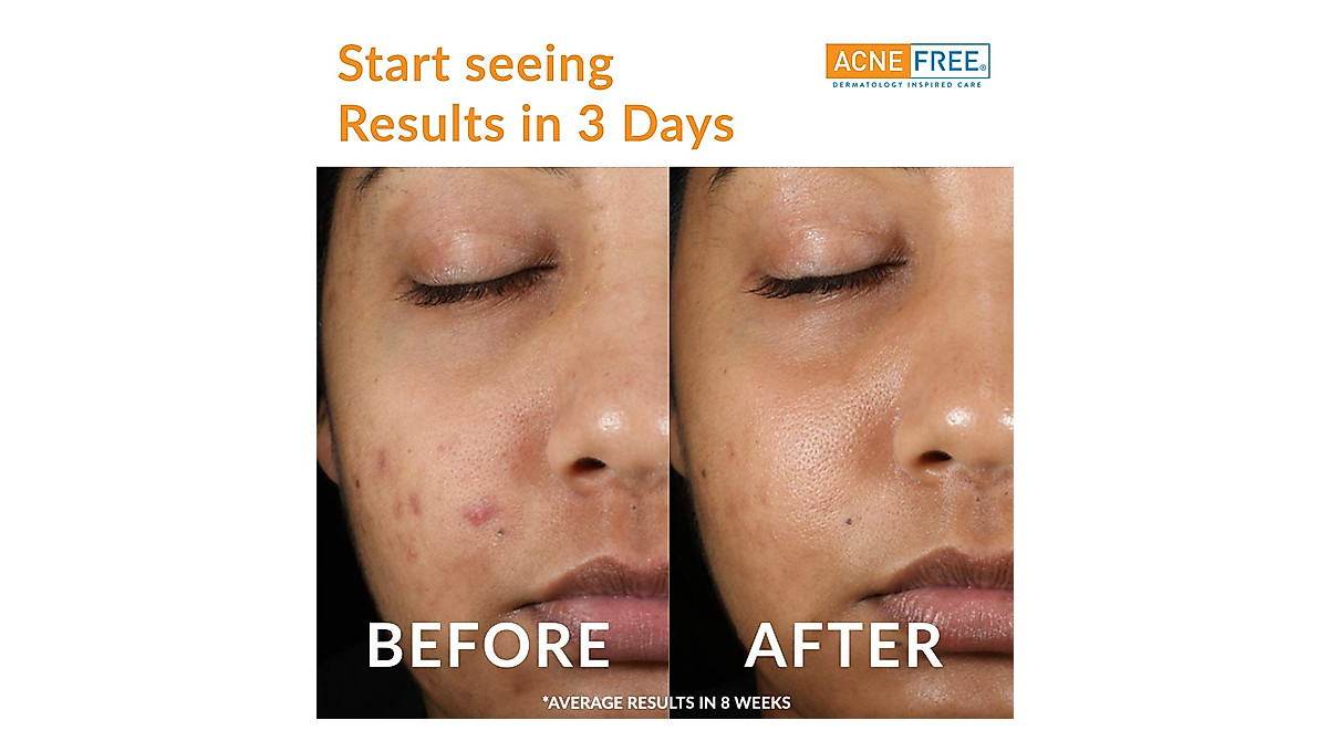 AcneFree 24 Hour Acne Clearing System - Pack of 2