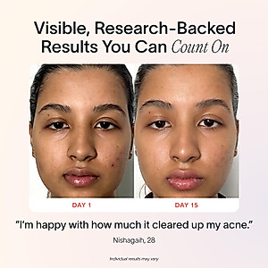 Solawave Bye Acne: 3-Minute Pimple Spot Treatment with Blue Light Therapy and Red Light Therapy - Handheld Device for Breakouts and Face Care