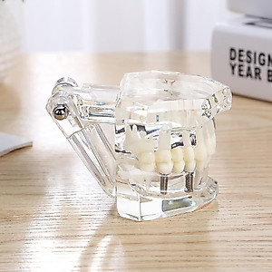 Dentalmall Dental Oral Typodont Model Implant Pathological Removable Teach Demo Visible Anatomy Demonstration Teaching Standard Size (Clear)