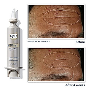 RoC Derm Correxion Fill + Treat Advanced Retinol Serum, Wrinkle Filler Treatment with Hyaluronic Acid for Forehead Wrinkles, Crow's Feet, Eleven Wrinkles, and Laugh Lines, 15ml