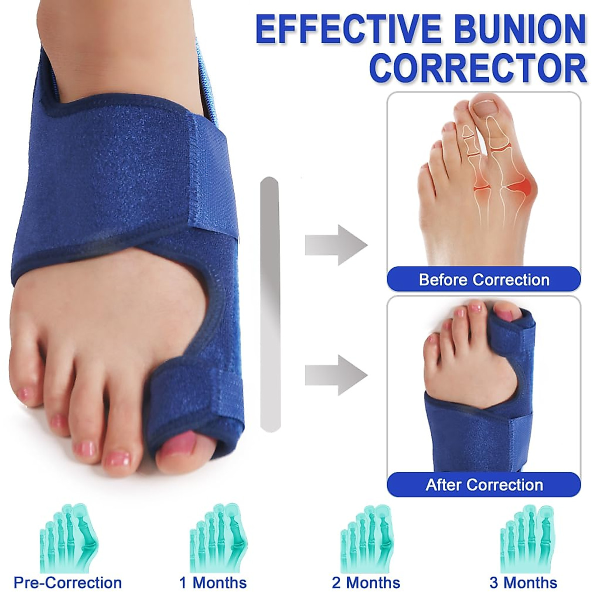 Toe Corrector Toe Separator Bunion Splint 【2024 Updated】 Hallux Valgus Bunion Big Toes Corrector Set Bunion Brace Bunion Exercise Strap Orthopedic Kit Bunion Pain Relief (free, Blue)