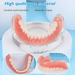 faruijie Overdenture Model - Implant Overdenture Model Lower Denture Model with Four Implants Dental Model Overdenture for Teaching and Studying