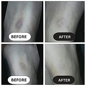 Dark Spot Corrector, Dark Spot Remover for Face, Melasma and Hyperpigmentation Treatment, Dark Spot Serum, Age Spot Remover, with Tyrostat, Kojic Acid, Alpha Arbutin, Mulberry Extract, Lactic Acid 1oz