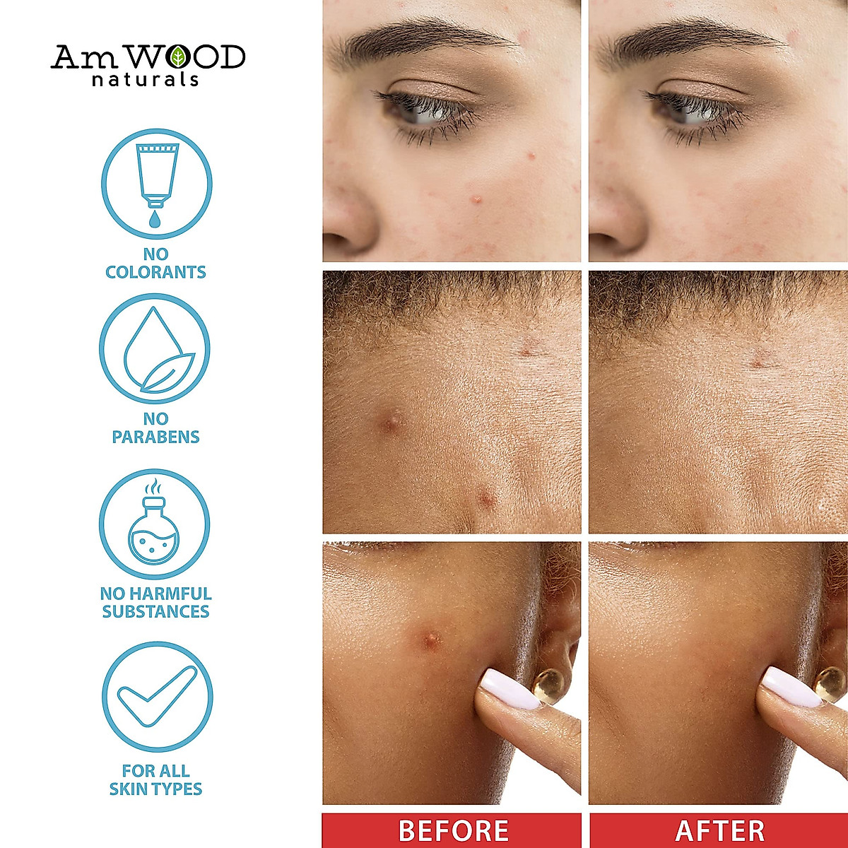 Acne Patches - Hydrocolloid Bandages with Salicylic & Hyaluronic Acids and Tea Tree Oil - Pimple Patches for Cystic Acne, Blemishes & Breakouts (120 Invisible Zit Stickers)