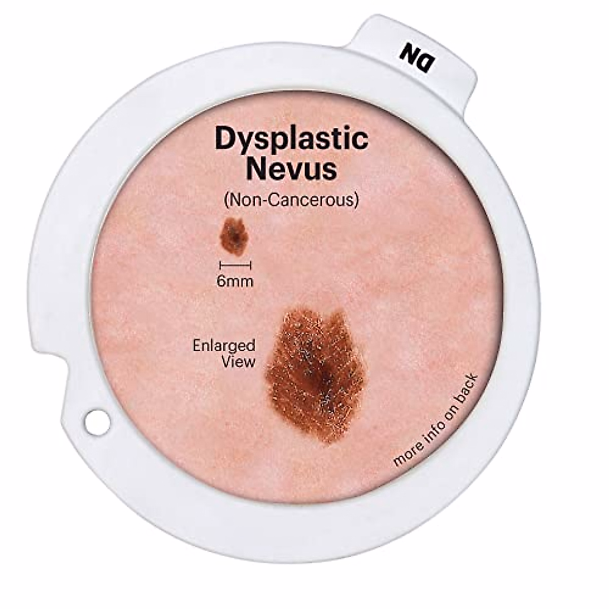 GPI Anatomicals - Skin Cancer Model, Replica with Precancerous and Cancerous Skin Lesions for Human Anatomy and Physiology Education, Anatomy Model for Doctor's Office, Medical Study Supplies