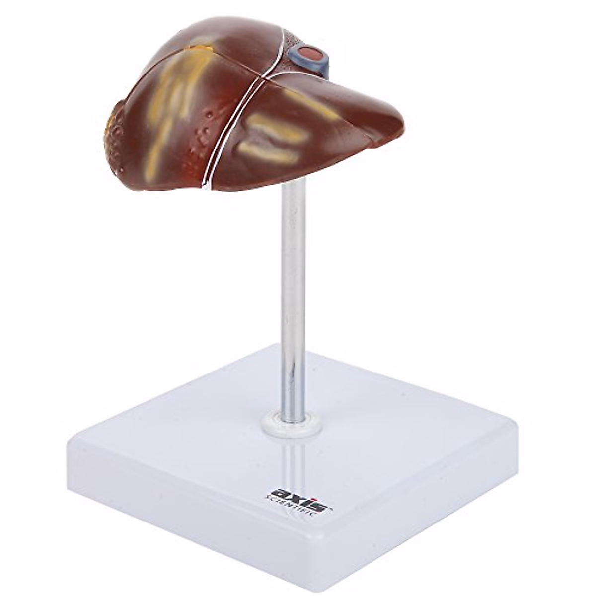 Axis Scientific Anatomy Model of Diseased Liver | Model is 1/3 Life-Size and Divides in 2 Parts | Shows 6 Liver Diseases and Abnormalities | Comes on a White Base