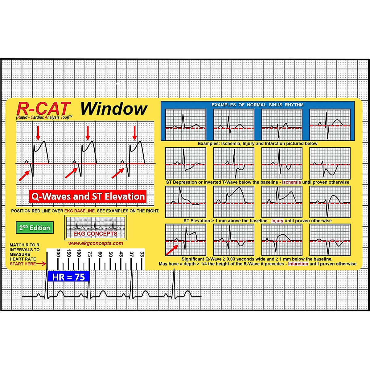 R-CAT EKG Window 2nd Edition