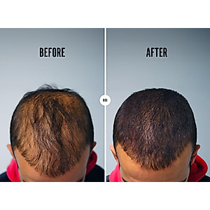 Revivogen MD Scalp Therapy Thinning Hair Solution and Bio-Cleansing Shampoo Set