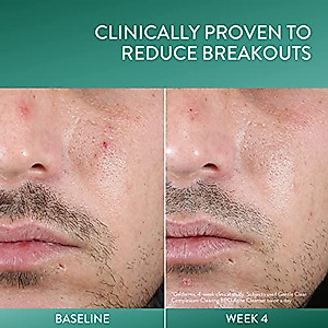 Cetaphil Gentle Clear Complexion-Clearing BPO Acne Cleanser with 2.6% Benzoyl Peroxide, Creamy and Soothing for Sensitive Skin, Suitable for All Skin Types, 4.2oz