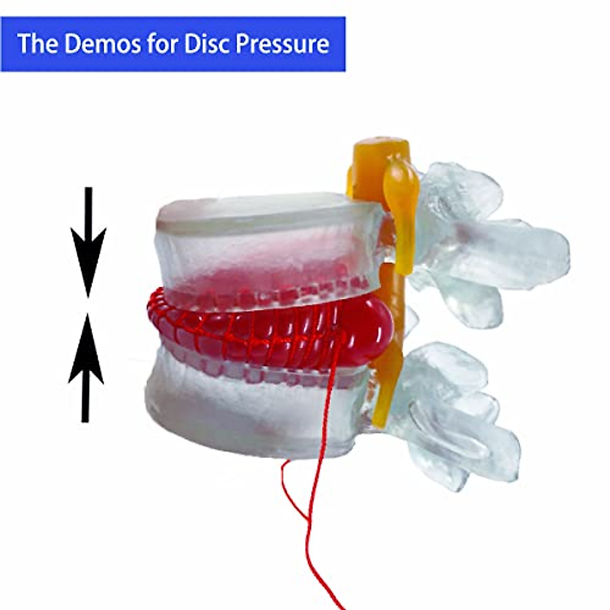 Veipho Human Anatomical Lumbar Disc Herniation Model, Transparency Lumbar Disc Herniation Model, Lumbar Disc Model for Teaching and Demonstrating