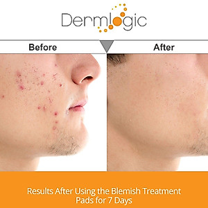 Acne Treatment Pads- Contains Salicylic, Glycolic, & Lactic Acid for Face & Body. Clears Away Clogged Pores, Oily Skin & Cystic Breakouts. Removes Dark Spots, Blackhead & Whitehead Pimples