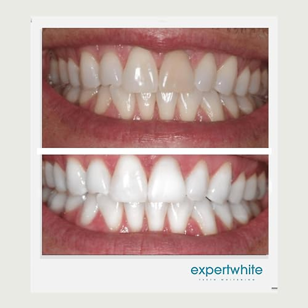 Expertwhite Teeth Whitening Gel Refills (6-gels). Made USA. 44 percent Carbamide Peroxide Tooth Bleaching Gel bleach For Invisalign style trays, Dental Grade Tooth Whitener. 6 syringes