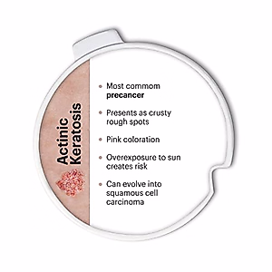 GPI Anatomicals - Skin Cancer Model, Replica with Precancerous and Cancerous Skin Lesions for Human Anatomy and Physiology Education, Anatomy Model for Doctor's Office, Medical Study Supplies