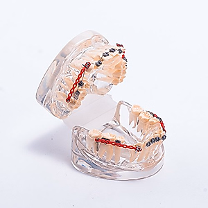 Easyinsmile Dental Orthodontic Treatment Model Teeth/Tooth/Denture Model with Braces for Dentist Studying Researching and Patient Education (Metal Bracket)