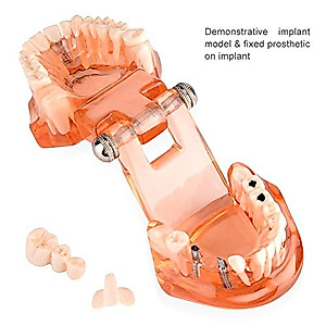 Maxmartt Teeth Model, Dental Demonstration Dental Implant Removable Study Model Teeth Teaching Model for Student Teacher, Orange