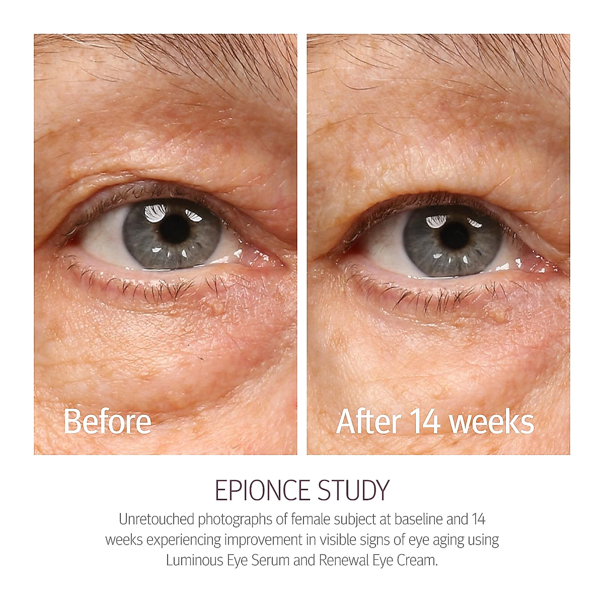 Epionce Renewal Eye Cream - Anti-Aging, Under Eye Cream for Dark Circles, Fine Lines, Wrinkles & Puffiness with Hyaluronic Acid, For All Skin Types, Dermatologist Skincare