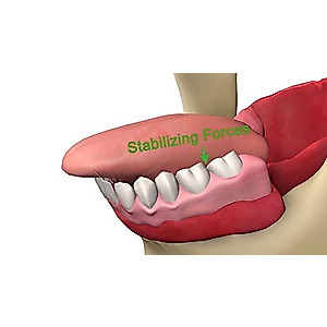 Lower Denture Stabilizers