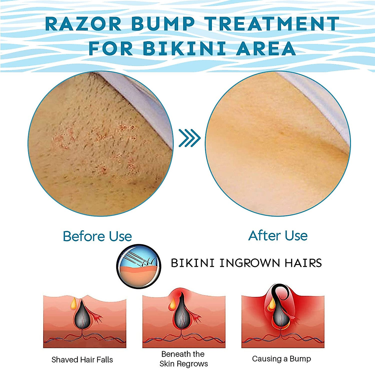 Ingrown Hair Treatment, After Shave Repair Serum For Ingrown Hairs & Razor Bump Treatment, Prevents Ingrown Hair Serum For Men and Women 100 Ml