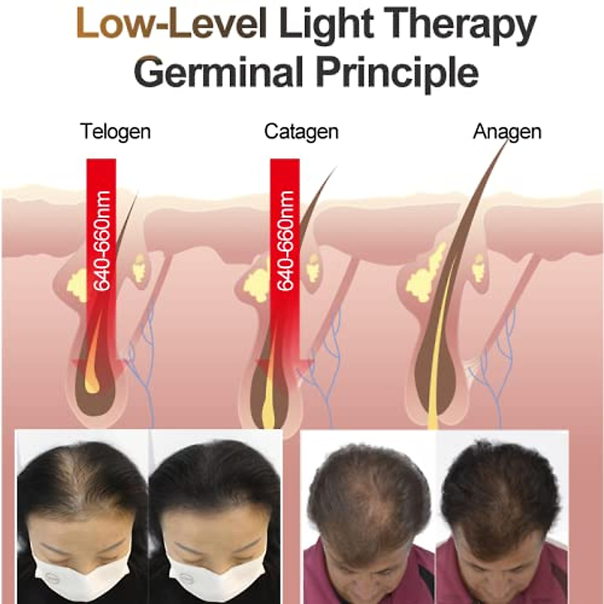 LESCOLTON Hair Growth System, FDA Cleared, 80 Laser Diodes Rechargeable Red Light Therapy Cap & Helmet Hair Regrowth and Hair Loss Treatment Device For Thinning Hair (2nd Generation)