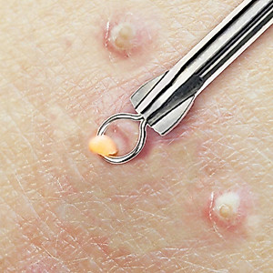 Beaute Galleria Needle Blackhead Remover Pimple Extractor Popper for Acne Comedone Blemish Whitehead Zit Removal Tool