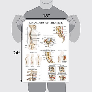Palace Learning Disorders of the Spine Anatomy Poster - Laminated Spinal Disorders Anatomical Chart - 18" x 24"