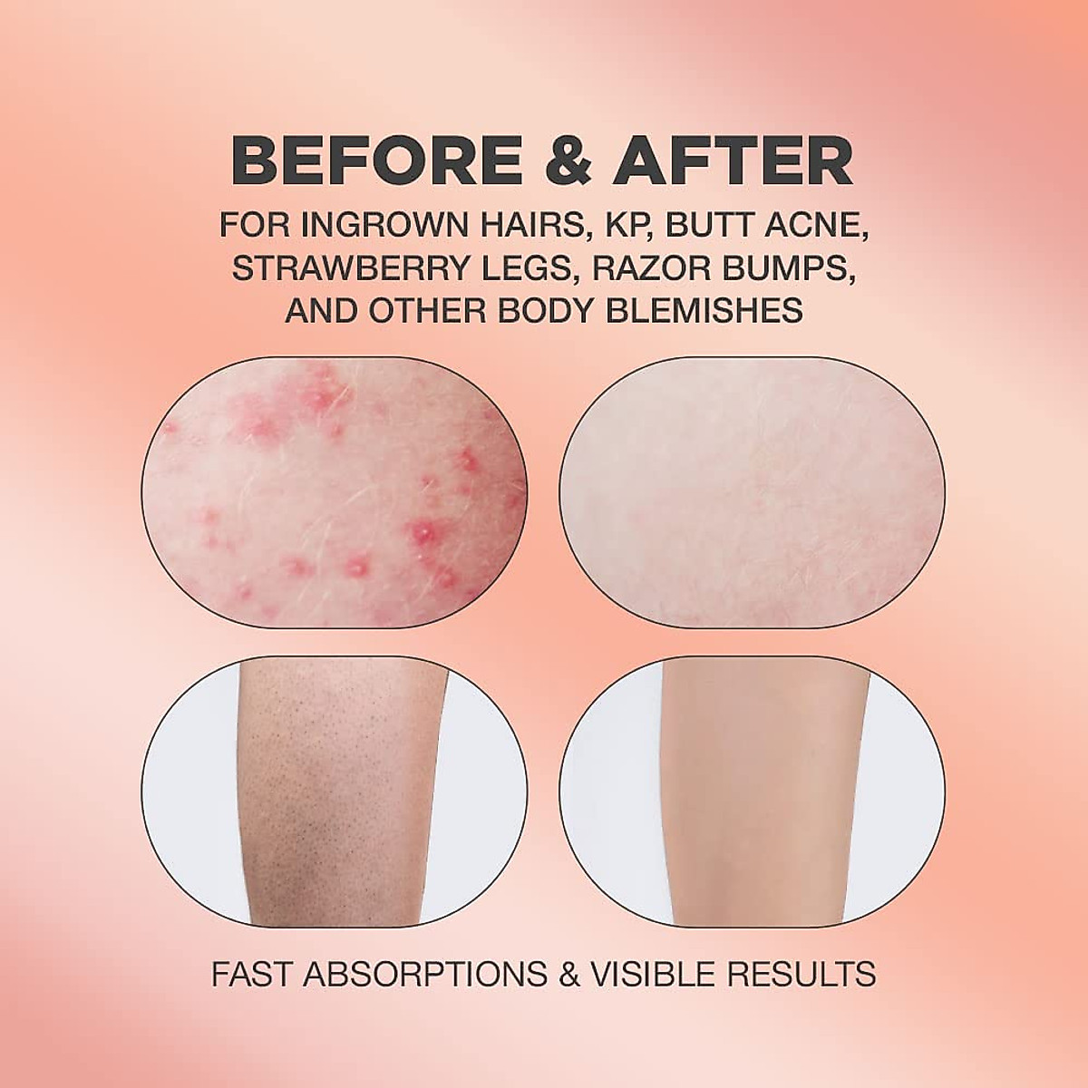 Ingrown Hair Pads | Ingrown Hair Pads with Body Exfoliating Serum for Ingrown Hairs, Strawberry Legs, Butt Acne and Razor Bumps | Ingrown Hair Pads with BHA Exfoliant | Glycolic Acid Pads | 60 Pads