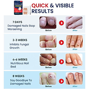 Multi-Purpose Fungus Nail Patches, Toenail Fungus Treatment, Nail Fungus Treatment for Toenail, Ingrown Toenail Treatment, Toe Nail Fungus Treatment Extra Strength, Nighttime Fungal Nail Patches