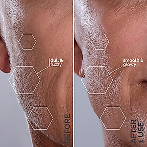 Michael Todd Beauty - Sonicsmooth – SONIC Technology Dermaplaning Tool - 2 in 1 Women’s Facial Exfoliation & Peach Fuzz Hair Removal System with 8 Weeks of Dermaplaning Blades