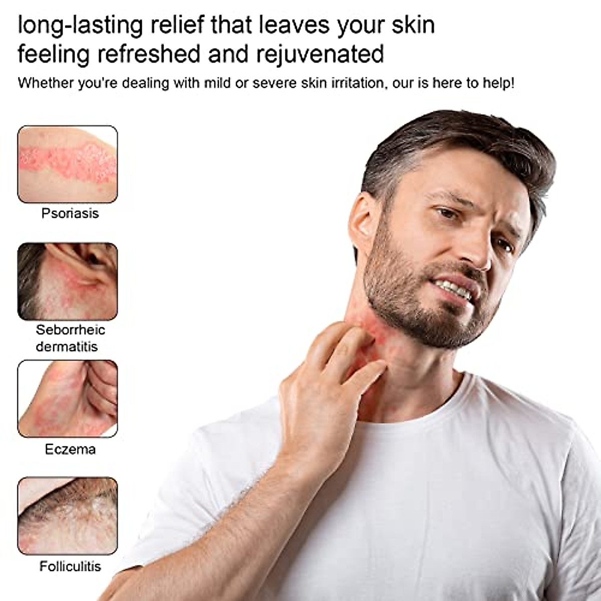 Eczema Psoriasis Manuka Relief Honey Cream, Hand Foot, Tinea Versicolor, Itchy Feet, Butt, Anal Itch, Scalp Dandruff, Bee Sting, Bites, Boil Cyst, Armpit, Adults Kids, Natural Organic Soothing