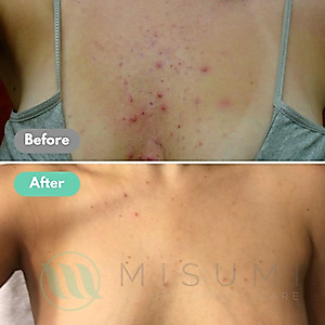 Misumi Acne Body Wash 120ml (4oz) - Keratosis Pilaris Treatment, Body & Back Acne Treatment - Salicylic Acid, Glycolic Acid AHA Body Wash for Men & Women Bacne