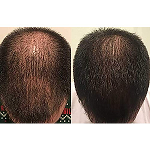Zenagen Revolve Thickening Hair Loss Treatment for Men, 6.75 Fl Oz
