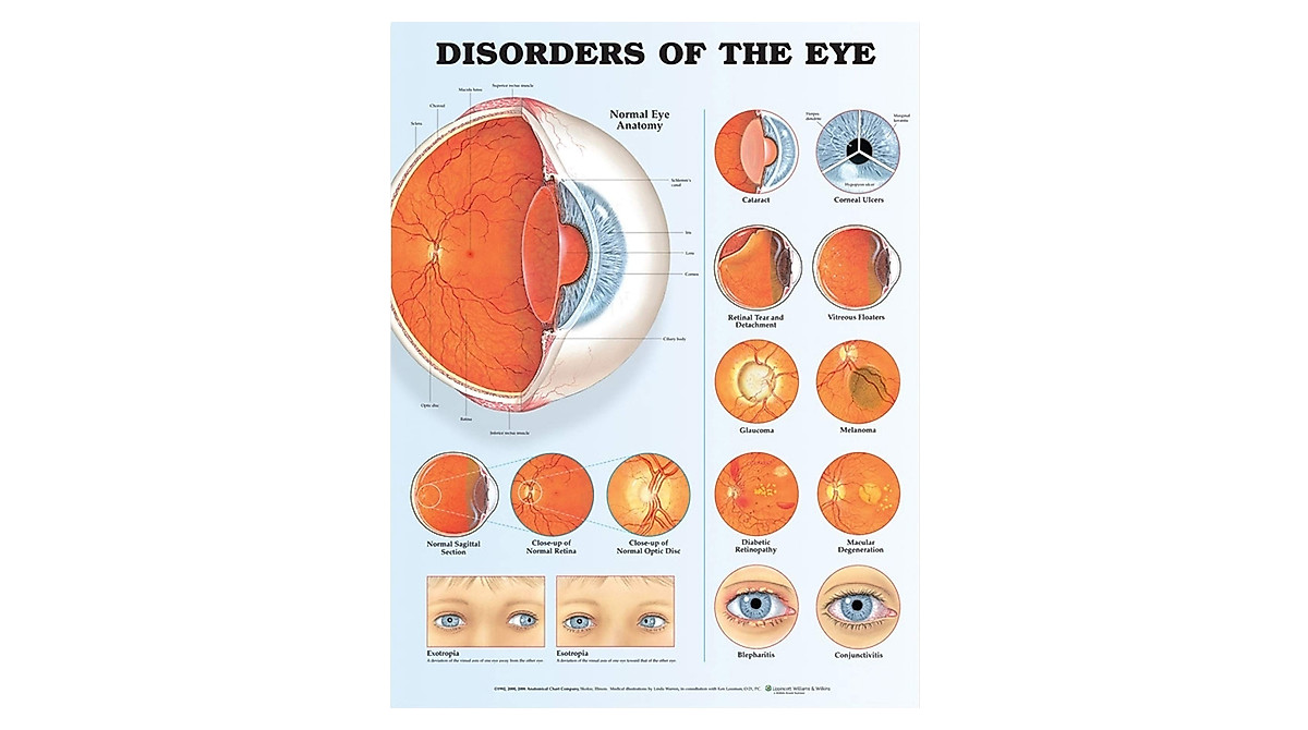 Disorders of the Eye Anatomical Chart - Medical Eye Disorder Guide