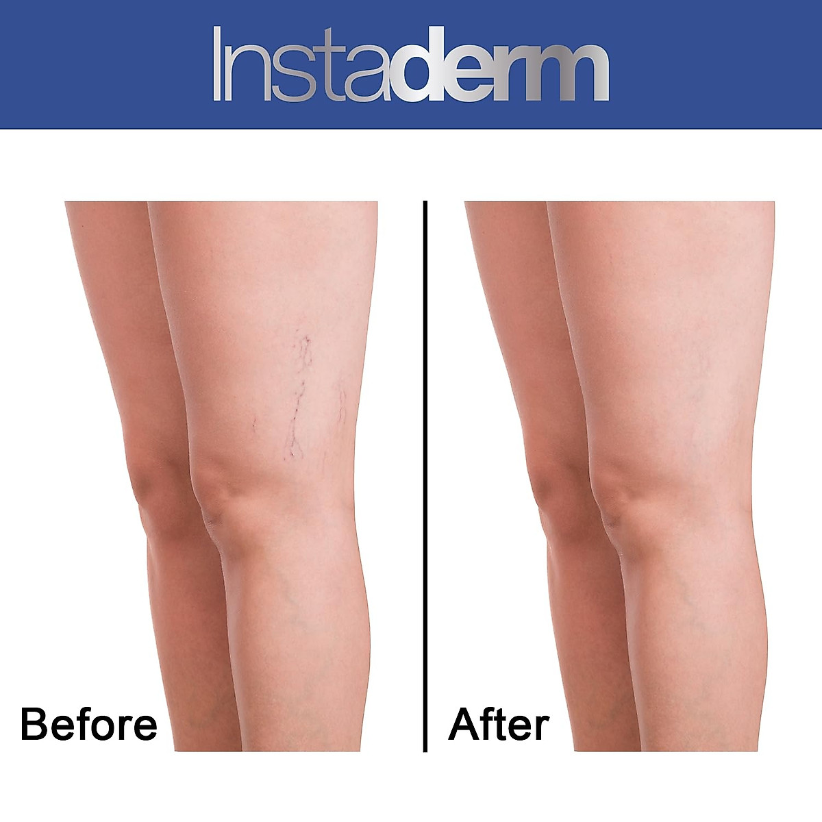 Instaderm Vitamin K Cream- Bruise Healing Formula with Arnica. Dark Spot Moisturizer for Bruising, Spider Veins & Broken Capillaries. Repair Under Eye Dark Circles, & Puffiness.