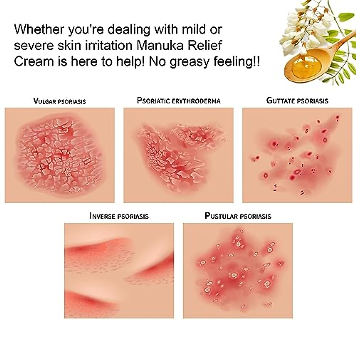 Eczema Psoriasis Manuka Relief Honey Cream, Hand Foot, Tinea Versicolor, Itchy Feet, Butt, Anal Itch, Scalp Dandruff, Bee Sting, Bites, Boil Cyst, Armpit, Adults Kids, Natural Organic Soothing