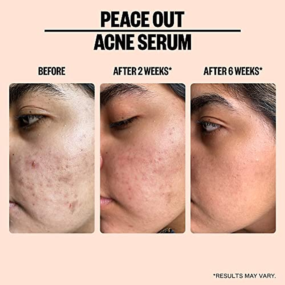 Peace Out Skincare Acne Serum. Daily Multi-Benefit Face Serum with 2% Salicylic Acid to Target Pimples, Zits, Blemishes and Breakouts, For Clearer-Looking Skin 1 fl oz