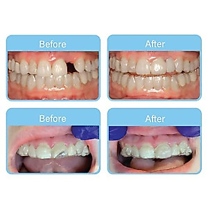 Aligner Pontics | Temporary Tooth Replacement for Aligner Trays and Retainers During Orthodontic Treatment (32 Count)