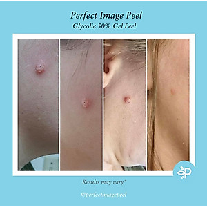 Glycolic Acid 50% Gel Peel - Enhanced with Retinol & Green Tea Extract (Professional Skin Peel)1 ounce