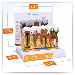 Dental Model | Human Body Anatomy Replica of Teeth w/Common Pathologies for Dentist Office Educational Tool | GPI Anatomicals